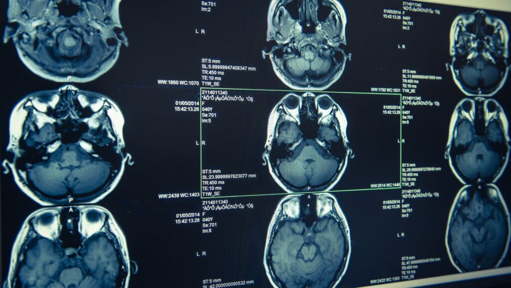 What Are Coup and Contrecoup Brain Injuries?